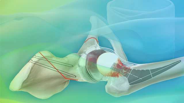 #040: Hip AutoCart™ Procedure for the Therapy of Acetabular Chondral ...