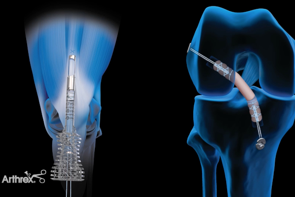 Insights into the Relationship between ACL Injuries and the Tibial ...